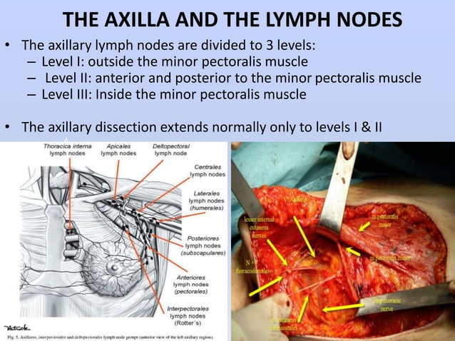 4 ΟΓΚΟΛΟΓΙΚΟ ΣΥΝΕΔΡΙΟ ΡΟΔΟΥ: Surgical management axilla. | PPT