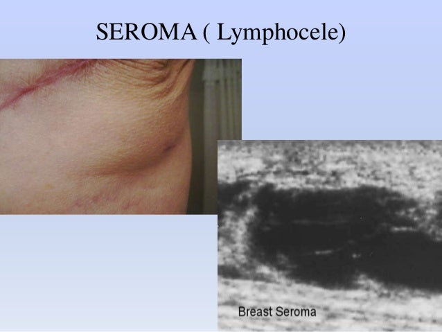 4 ΟΓΚΟΛΟΓΙΚΟ ΣΥΝΕΔΡΙΟ ΡΟΔΟΥ: Surgical management axilla.