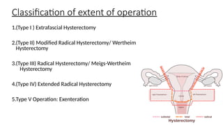 surgical management ca cervix and its nursing management .pptx