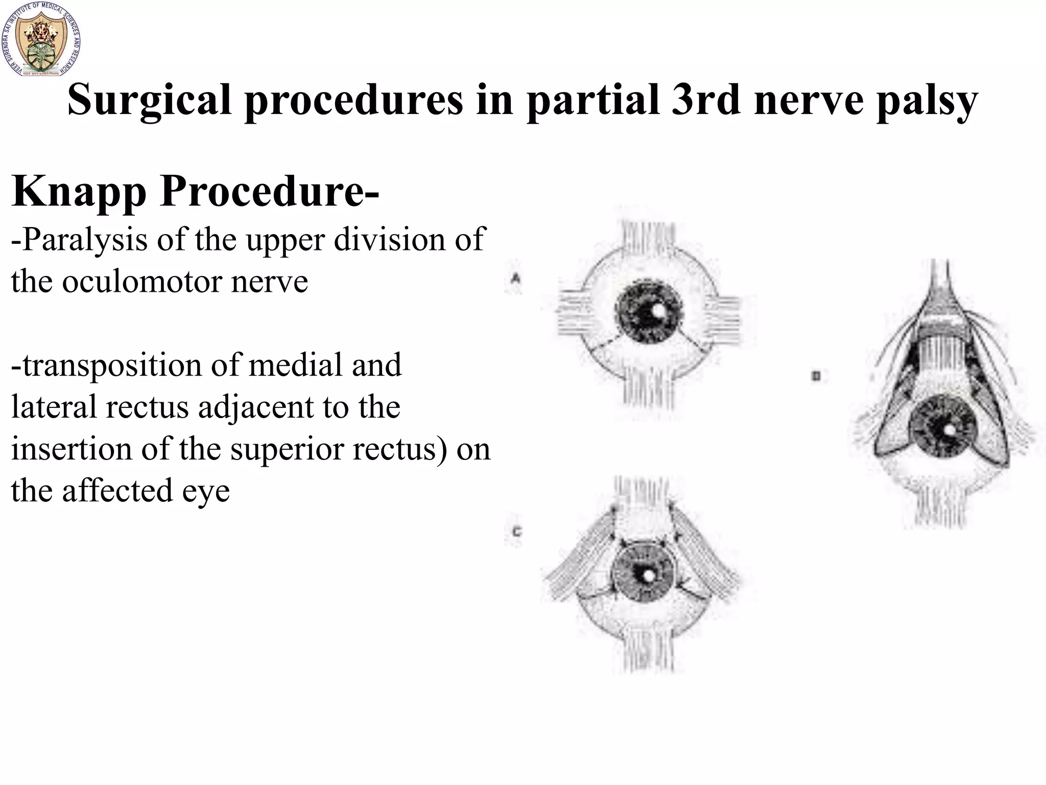 Surgical management in 3rd nerve palsy | PPTX