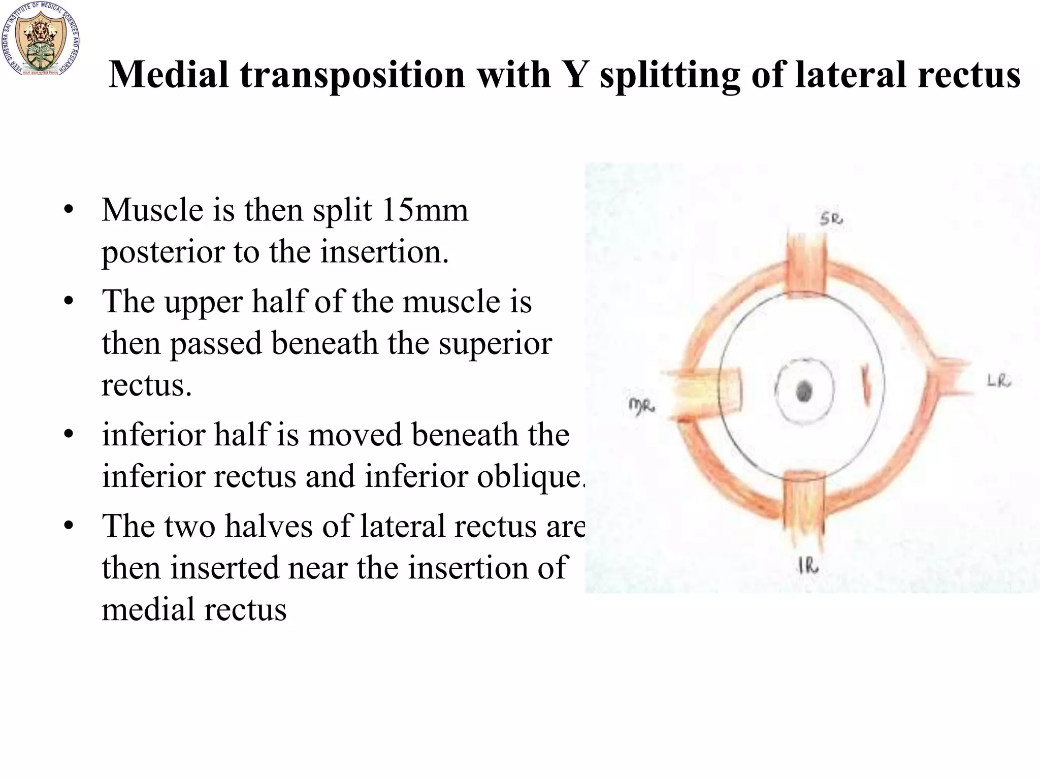 Surgical management in 3rd nerve palsy | PPTX