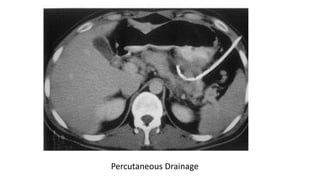 Surgical management of acute pancreatitis | PPTX