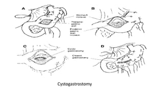 Surgical management of acute pancreatitis | PPTX