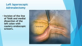 Surgical management of adrenal tumors | PPTX