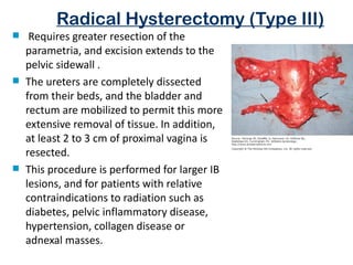 Surgical management of carcinoma cervix | PPT