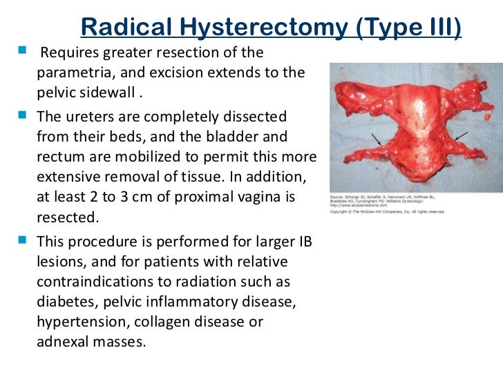 Surgical Management Of Carcinoma Cervix