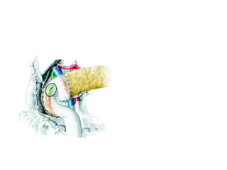 Surgical management of chronic pancreatitis. | PPTX