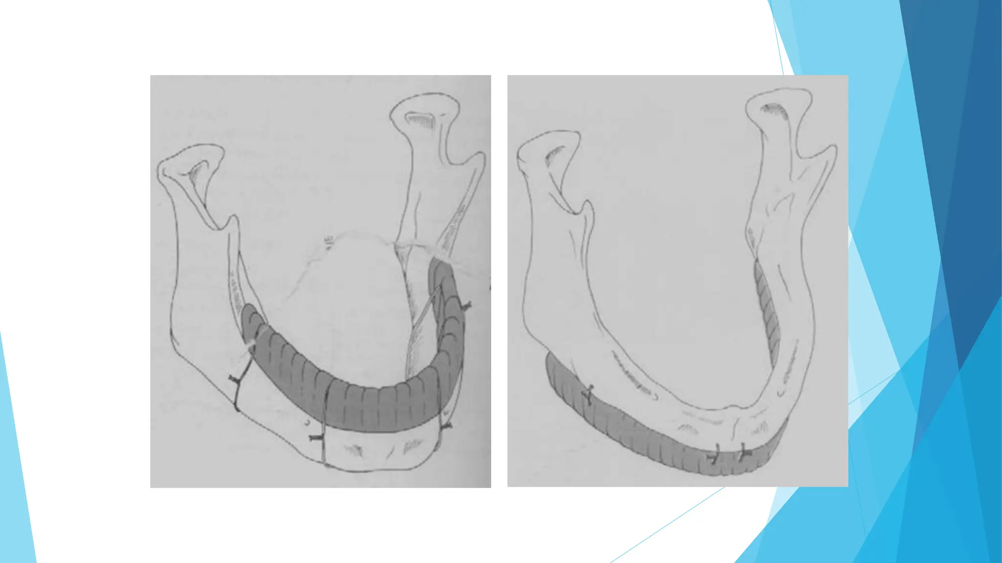 SURGICAL MANAGEMENT OF COMPLETE DENTURE PATIENT | PPTX