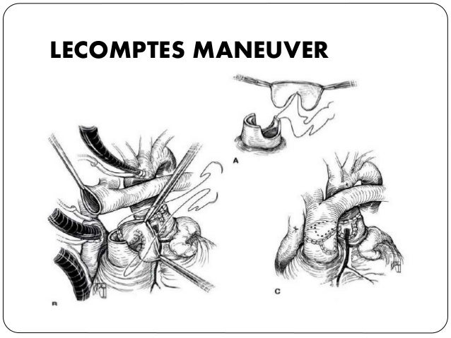 Surgical management of d-tga Dr. ankit jain AIIMS
