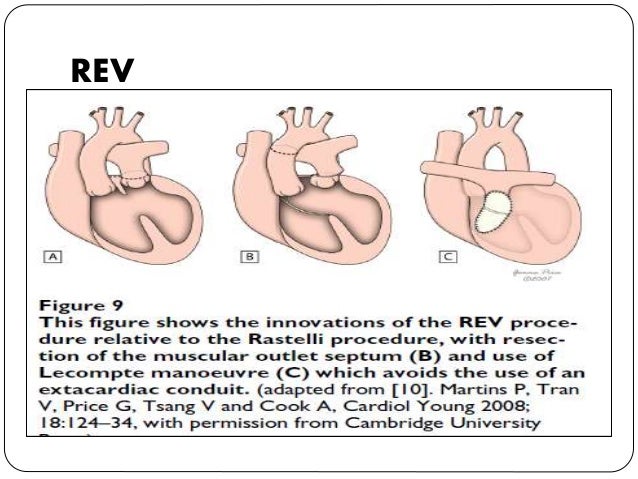 Surgical management of d-tga Dr. ankit jain AIIMS