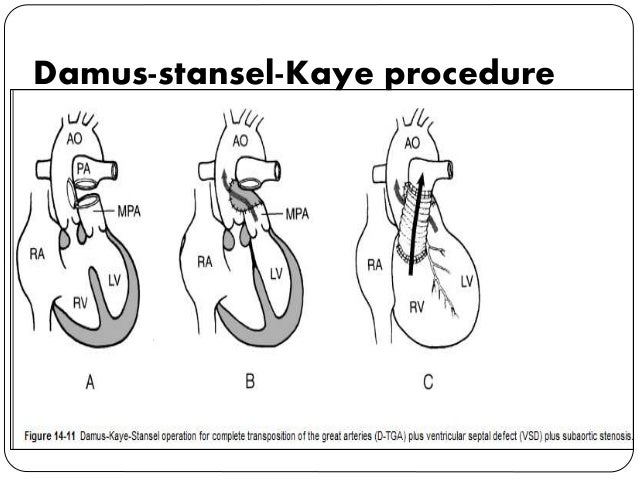 Surgical management of d-tga Dr. ankit jain AIIMS