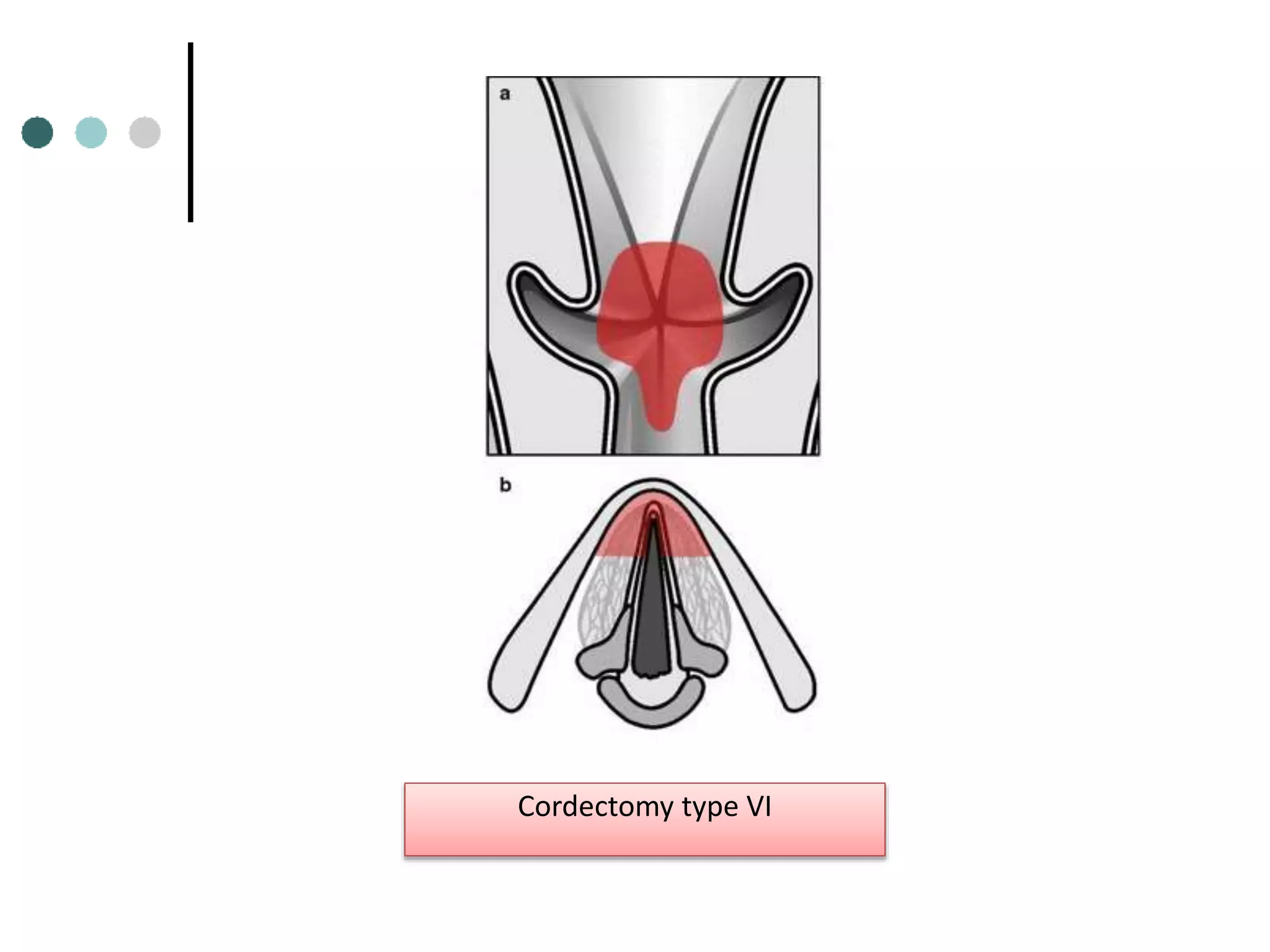 Surgical management of early laryngeal cancer dr.bhavin | PPTX