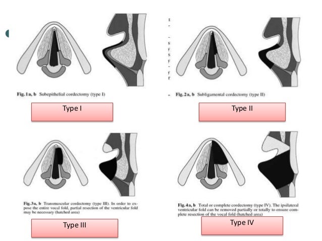 Surgical management of early laryngeal cancer dr.bhavin