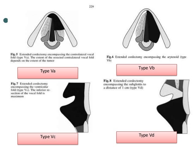 Surgical management of early laryngeal cancer dr.bhavin