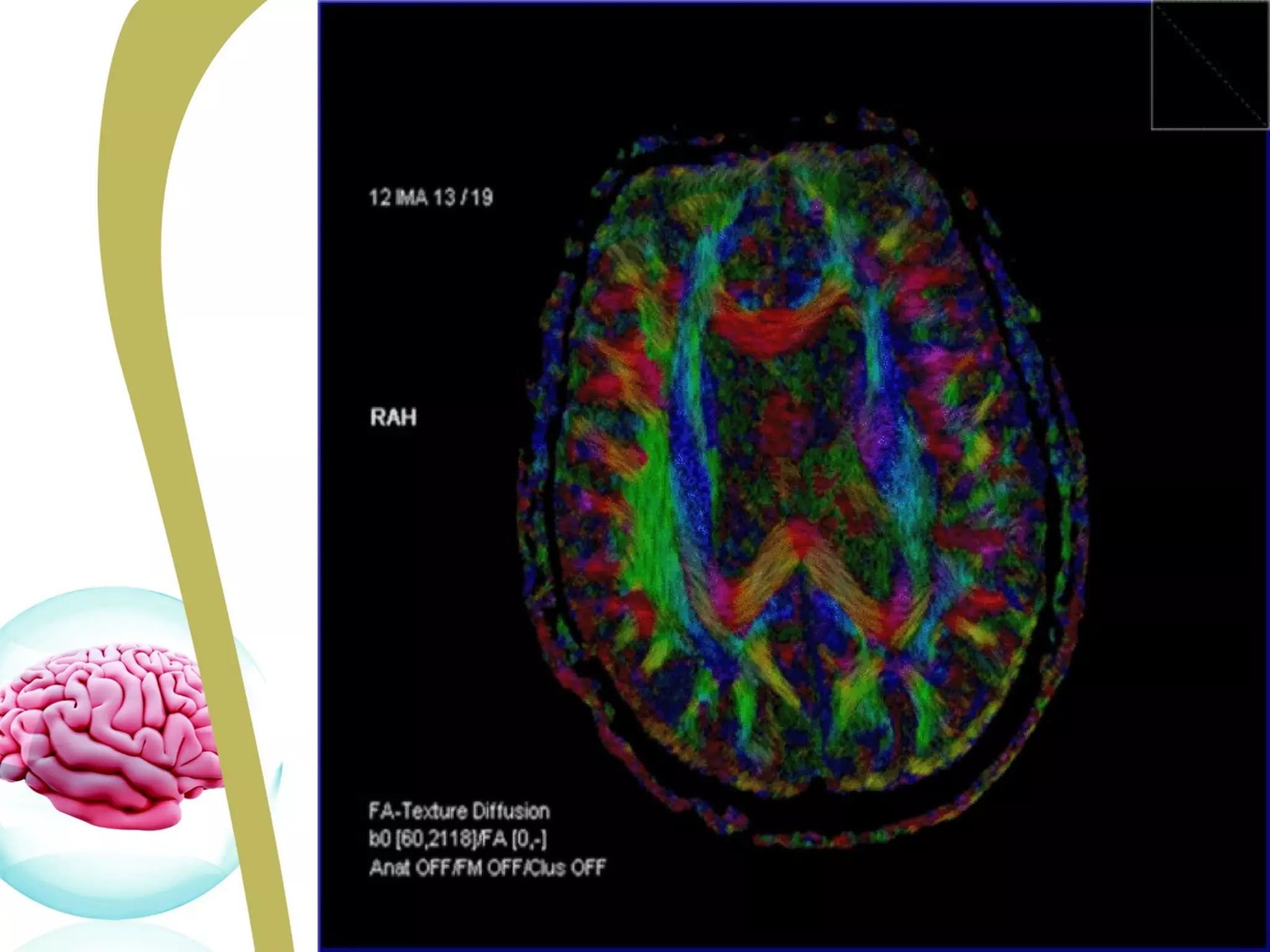 Surgical management of epilepsy | PPT