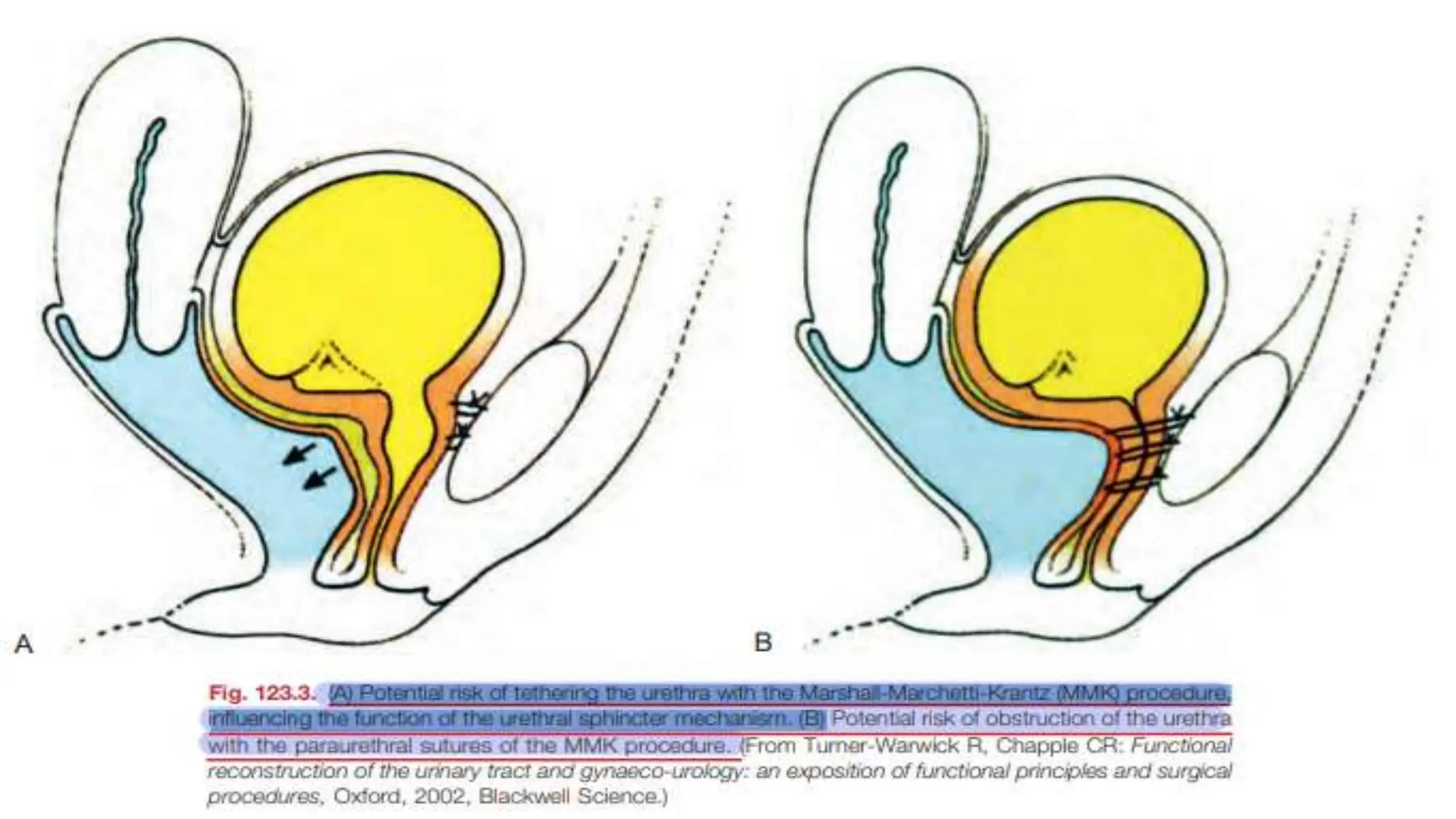 Surgical management of female stress urinary incontinence.pptx