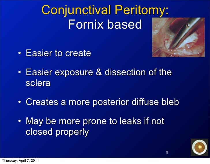 Surgical management of glaucoma pgs