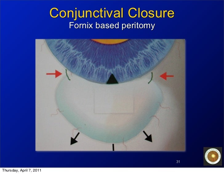 Surgical management of glaucoma pgs