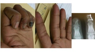 Surgical management of hand, wrist and elbow injuries | PPTX