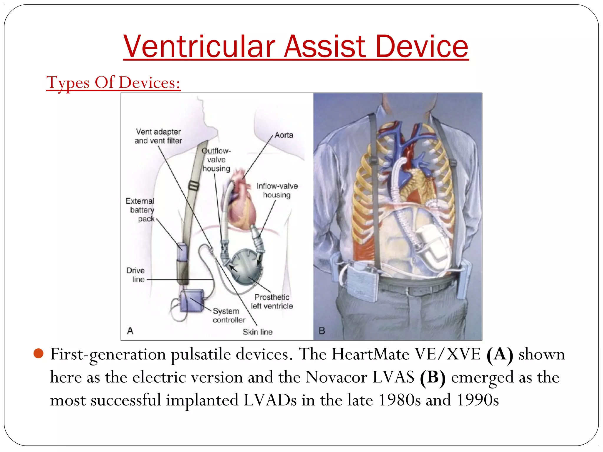 Surgical management of heart failure | PPT