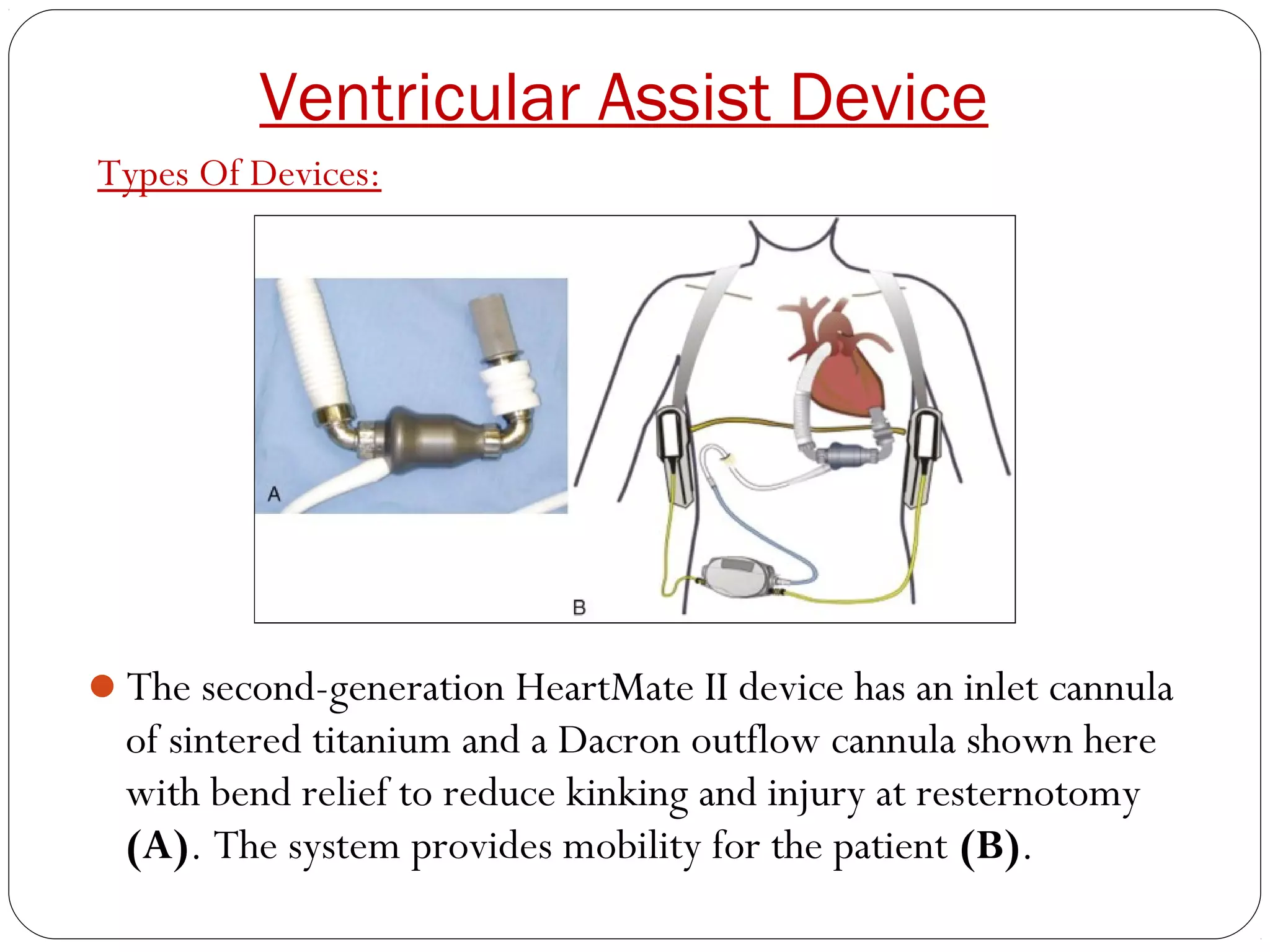 Surgical management of heart failure | PPT