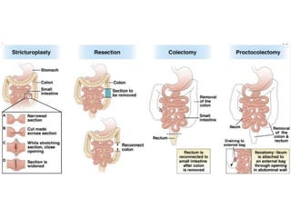 surgical management of IBD - emergency and elective.ppt