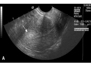 Surgical management of menorrhagia | PDF