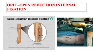 SURGICAL MANAGEMENT OF MUSCULO SKELETAL SYSTEM.pdf