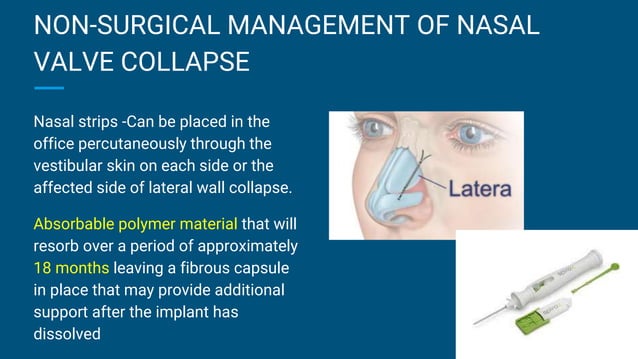 Surgical Management of Nasal Valve Insufficiency .pptx | Ear, Nose and ...