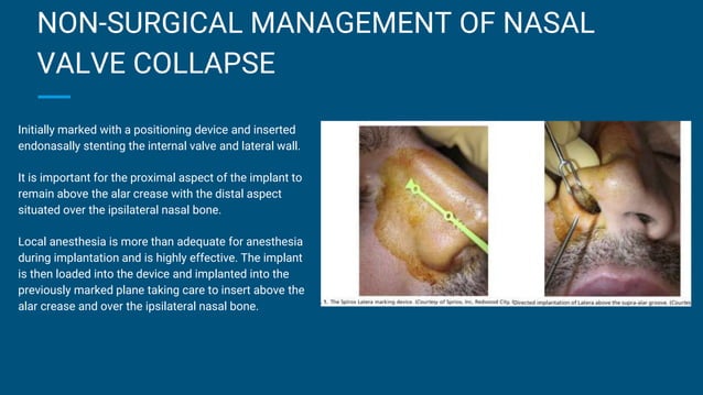 Surgical Management of Nasal Valve Insufficiency .pptx | Ear, Nose and ...