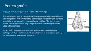 Surgical Management of Nasal Valve Insufficiency .pptx