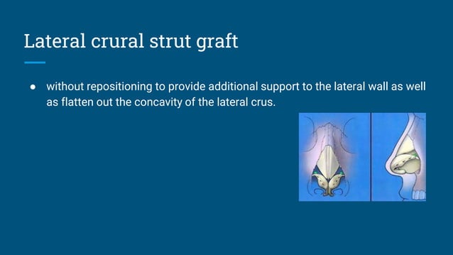 Surgical Management of Nasal Valve Insufficiency .pptx | Ear, Nose and ...