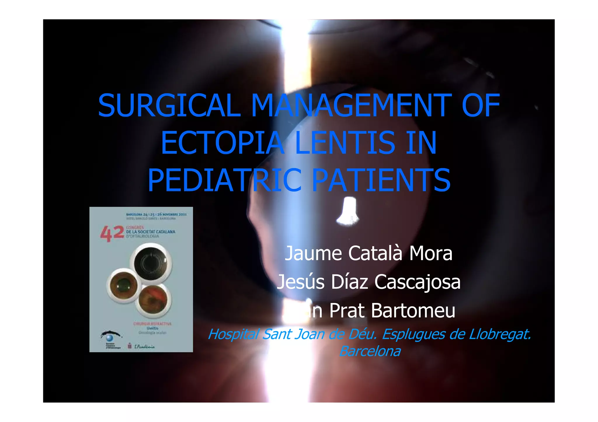 Surgical management of non pediatric ectopia lentis | PDF