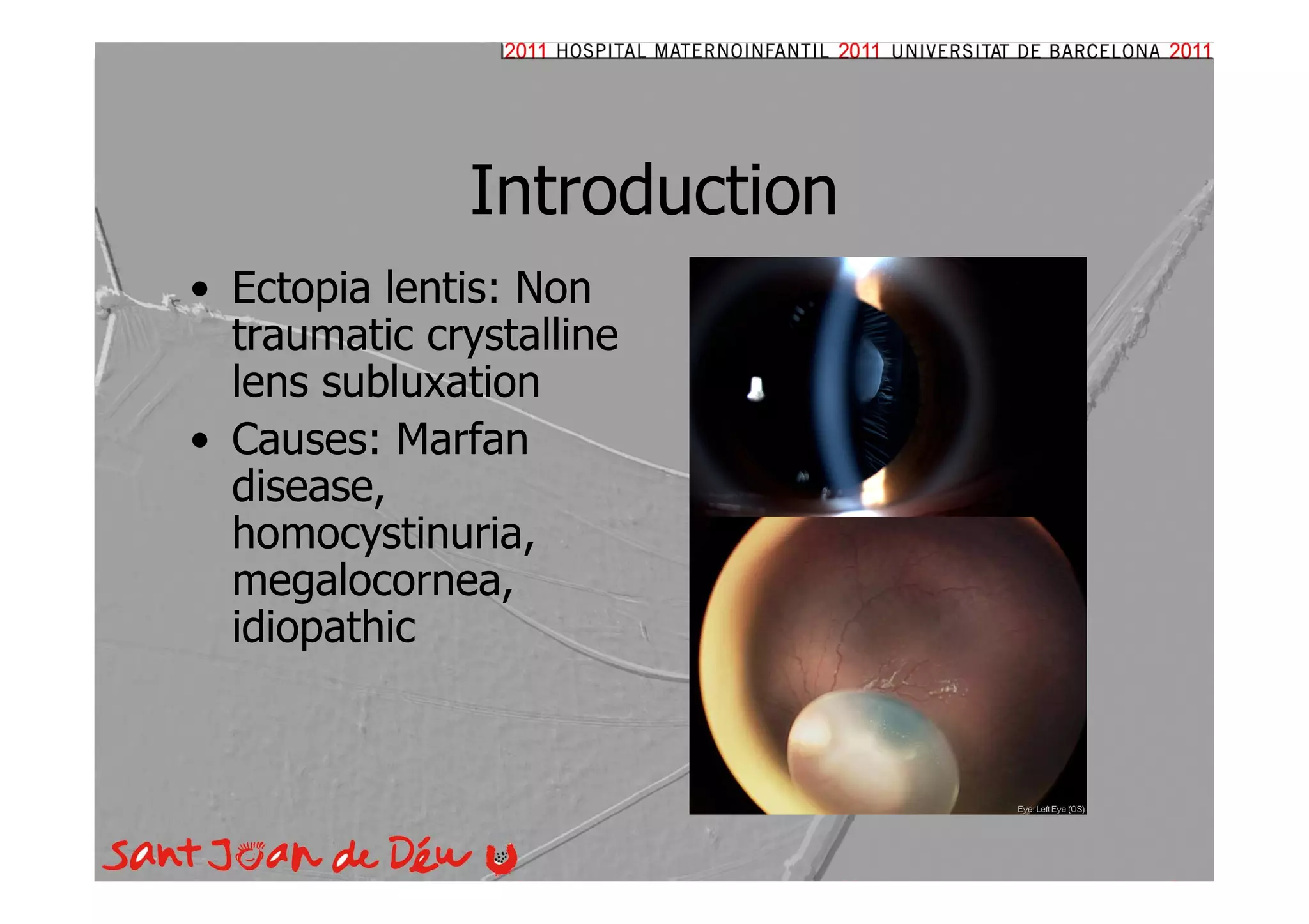 Surgical management of non pediatric ectopia lentis | PDF | Eye and ...