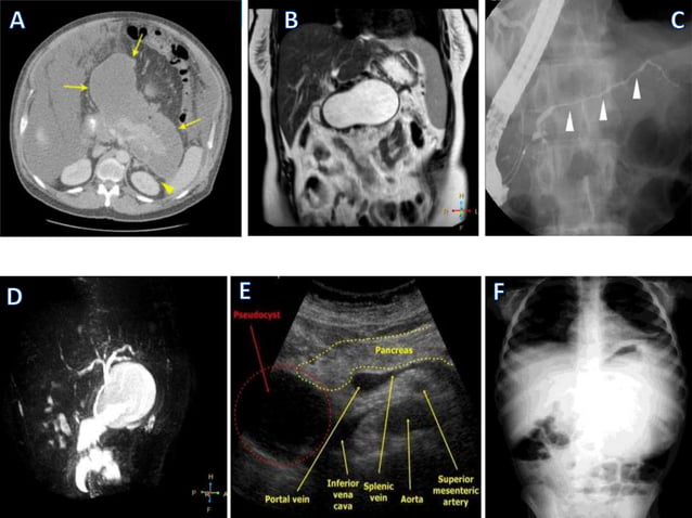 Surgical management of pancreatic pseudocyst..by dr chris alumona ...