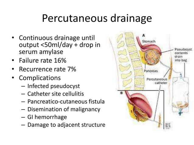 Surgical management of pancreatic pseudocyst..by dr chris alumona ...