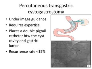 Surgical management of pancreatic pseudocyst..by dr chris alumona | PPT