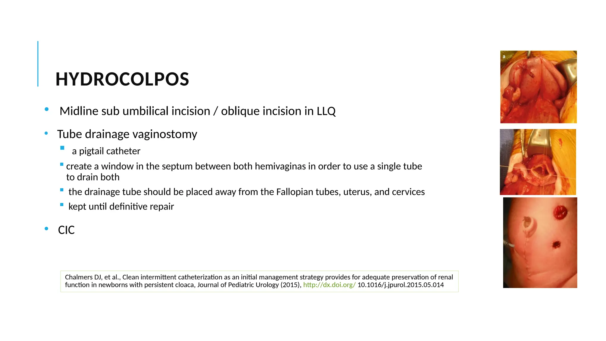surgical management of Persistent cloaca (2).pptx