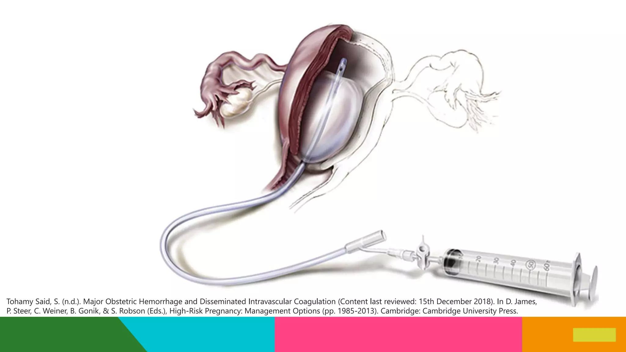 Surgical management of Postpartum Hemorrhage | PPTX