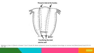 Surgical management of Postpartum Hemorrhage | PPTX