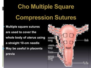 Surgical management of pph at tertiary center | PPT
