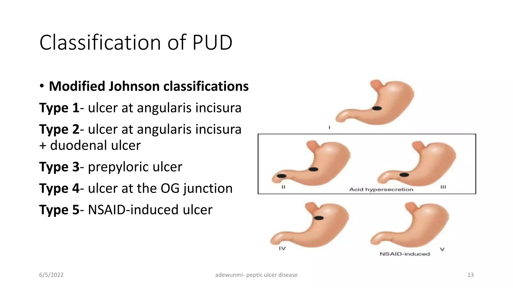 Surgical management of Peptic Ulcer Disease.pptx
