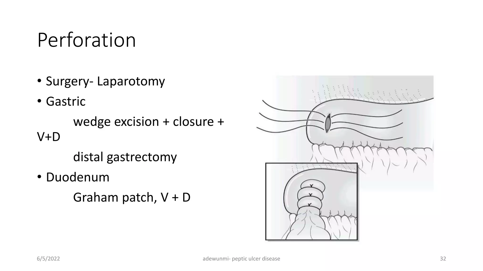 Surgical management of Peptic Ulcer Disease.pptx