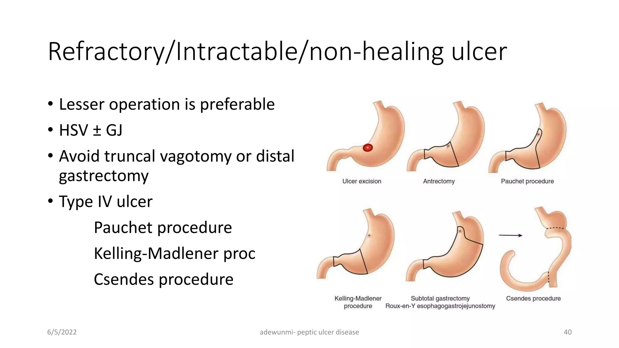 Surgical management of Peptic Ulcer Disease.pptx | Digestive Disorders ...