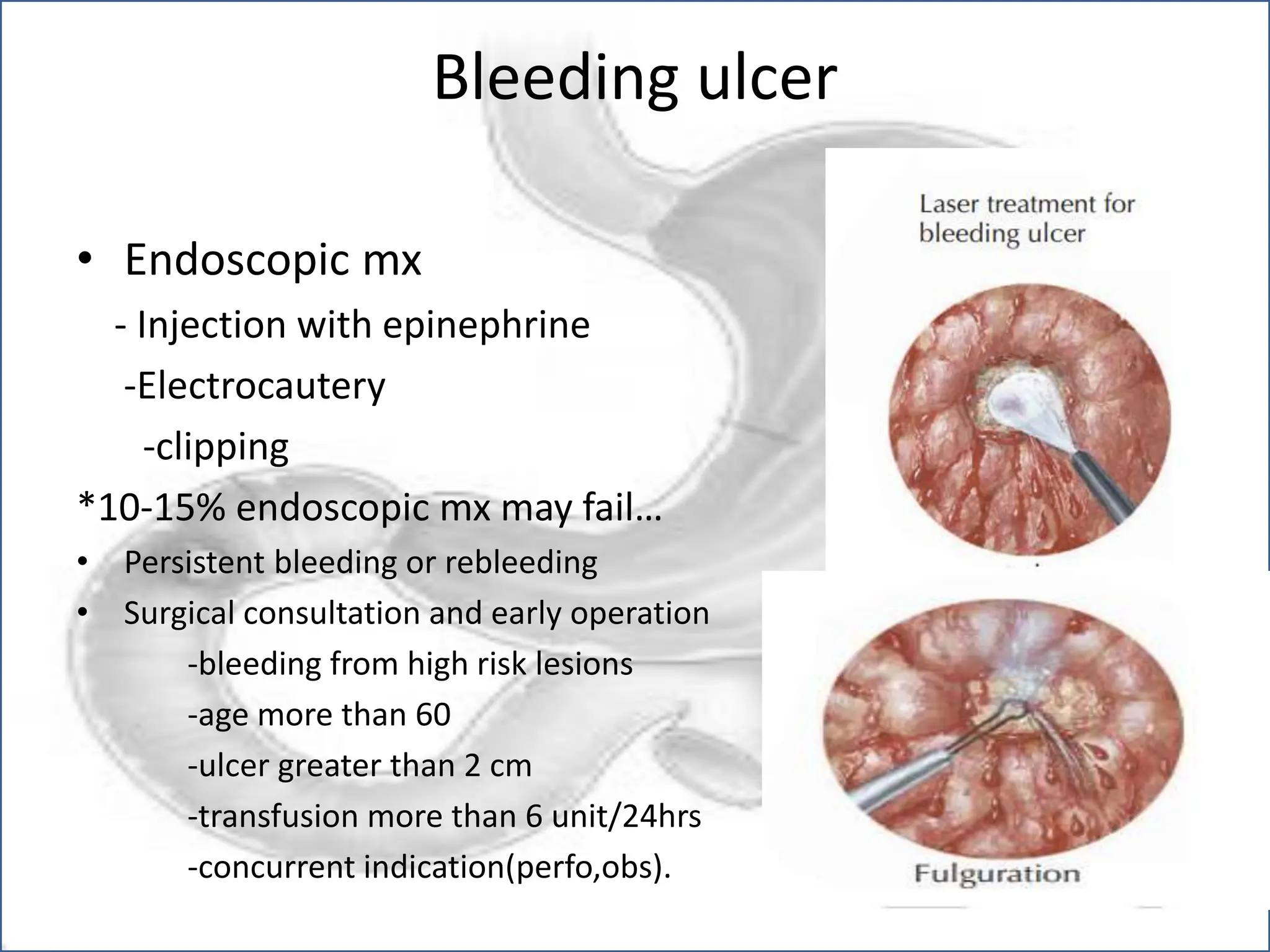 Surgical Management of PUD complications may 2024.pptx