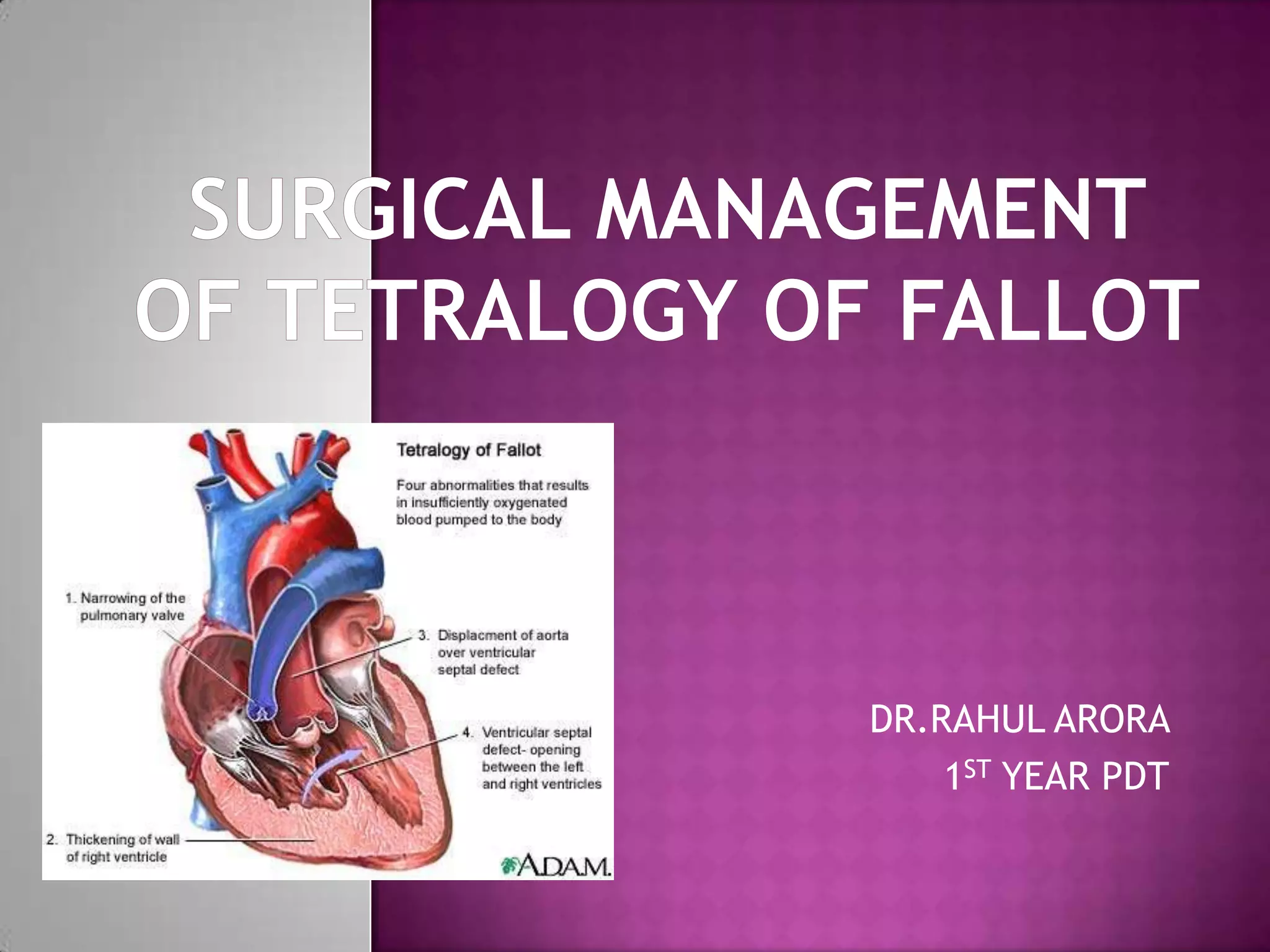 Surgical management of tetralogy of fallot | PPTX
