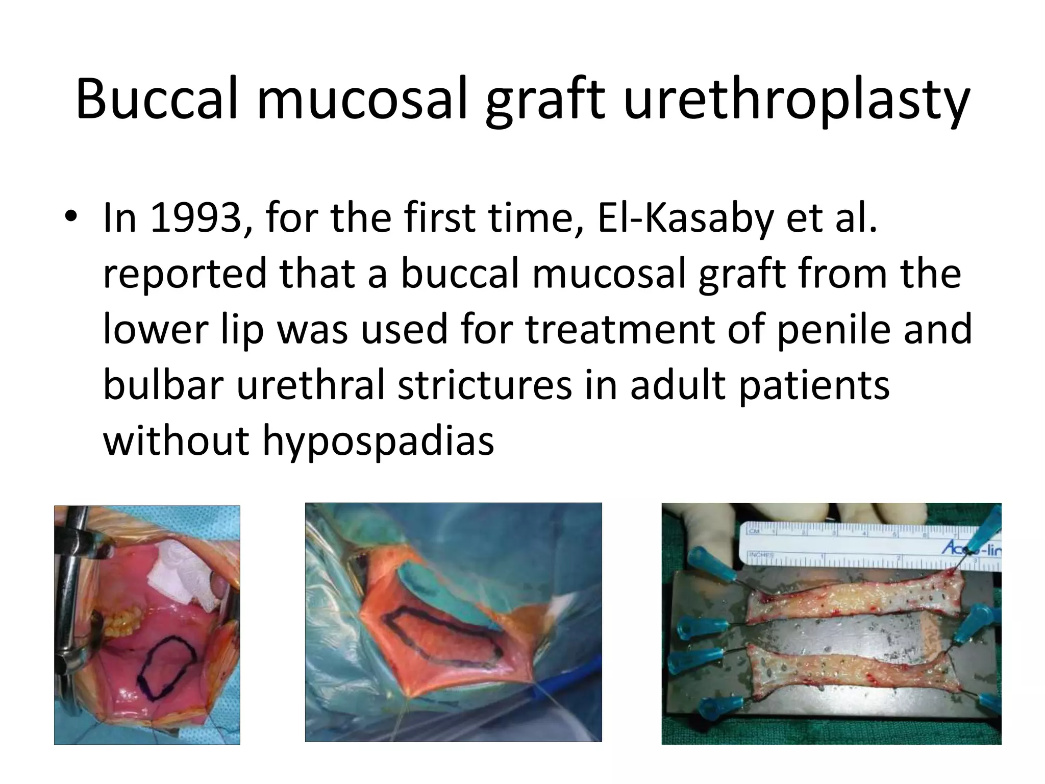 Surgical management of urethral stricture | PPTX