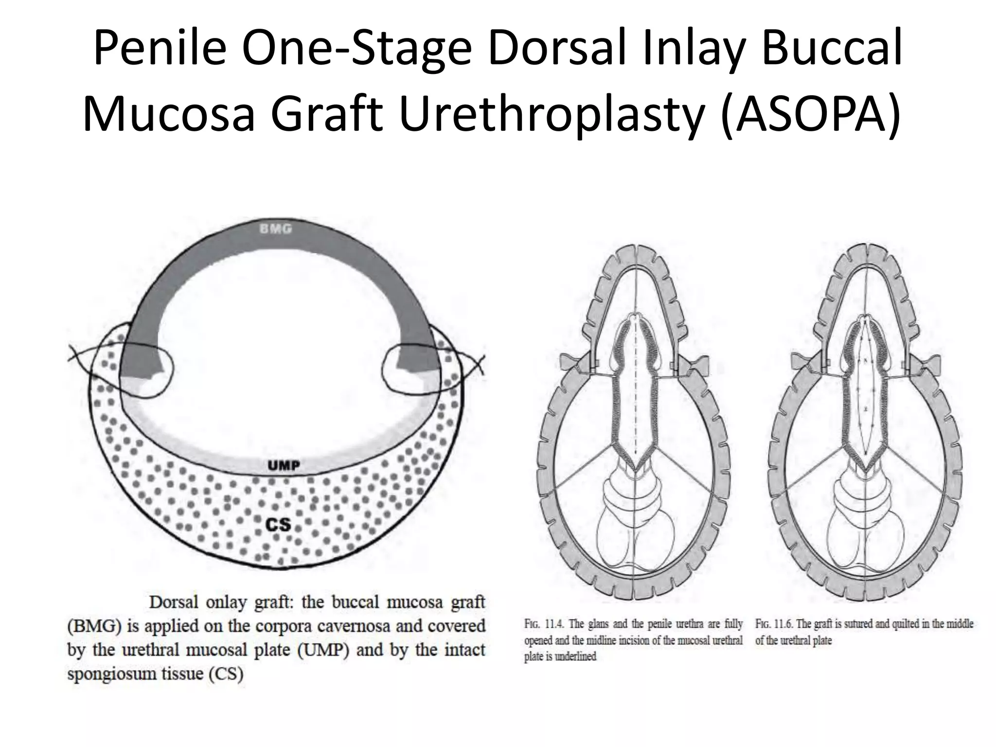 Surgical management of urethral stricture | PPTX