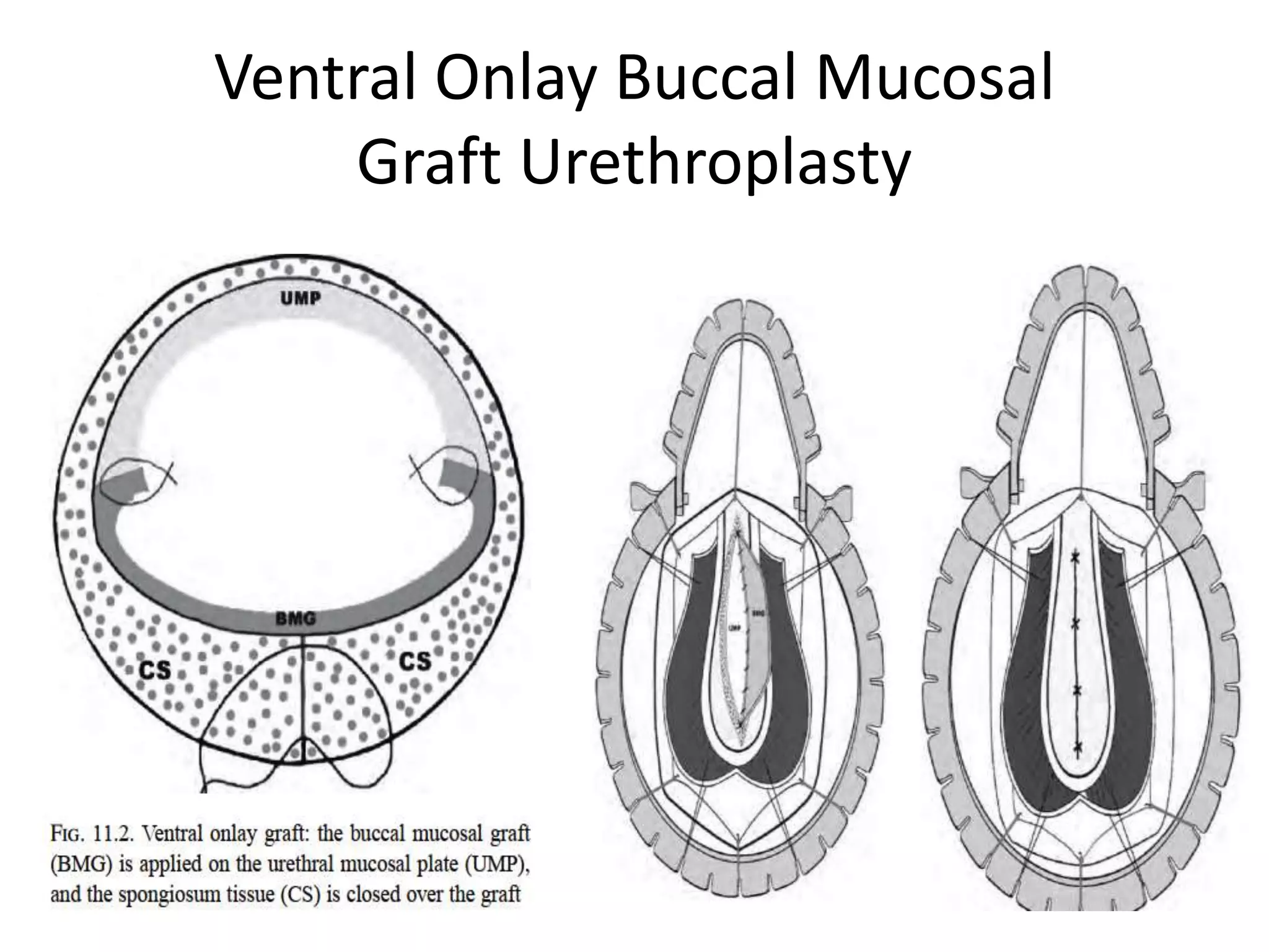 Surgical management of urethral stricture | PPTX