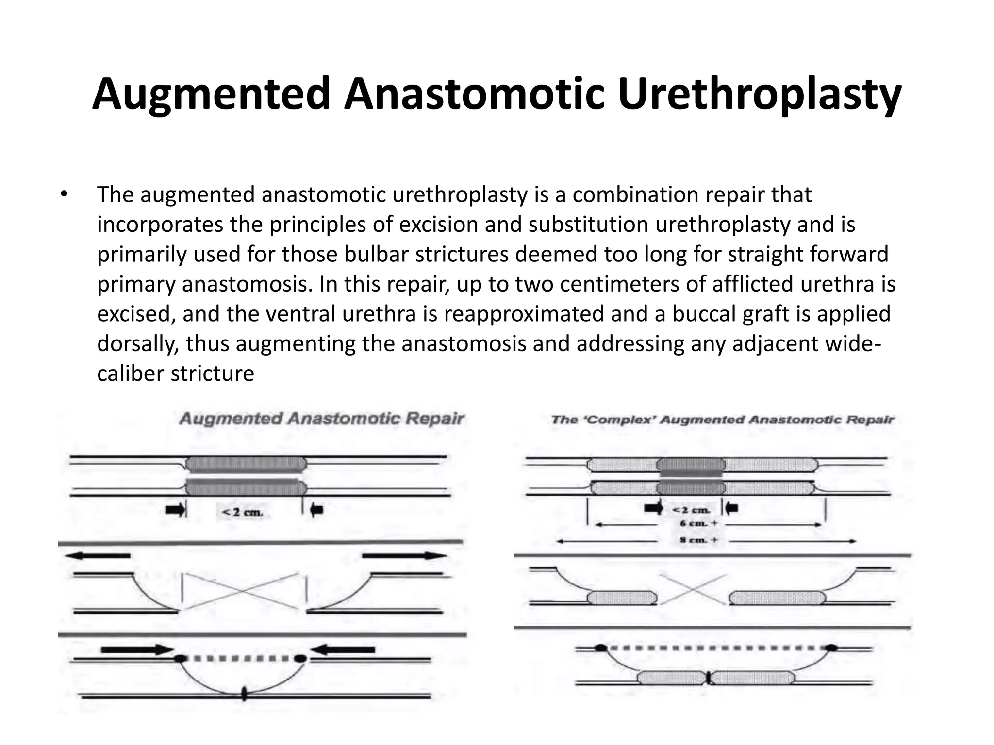 Surgical management of urethral stricture | PPTX